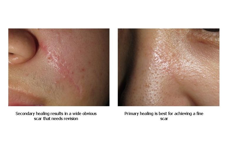 Soft Tissue Injuries of the Face – Aesthetic & Reconstructive Centre